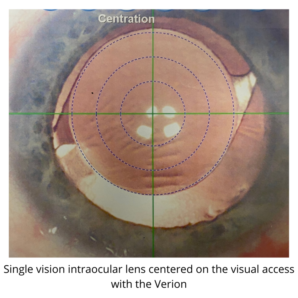 Cataract Surgery Chicago | Cataract Treatment Hoffman Estates